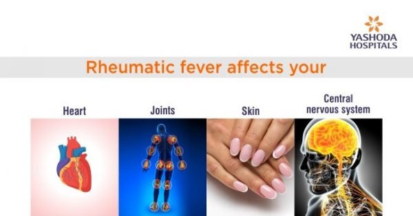 Rheumatic Fever (Acute Rheumatic Fever or ARF): Symptoms, Causes ... Rheumatic Fever (Acute Rheumatic Fever or ARF): Symptoms, Causes ...